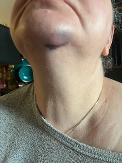 Bruises | Hell onWheels/Life One Handed